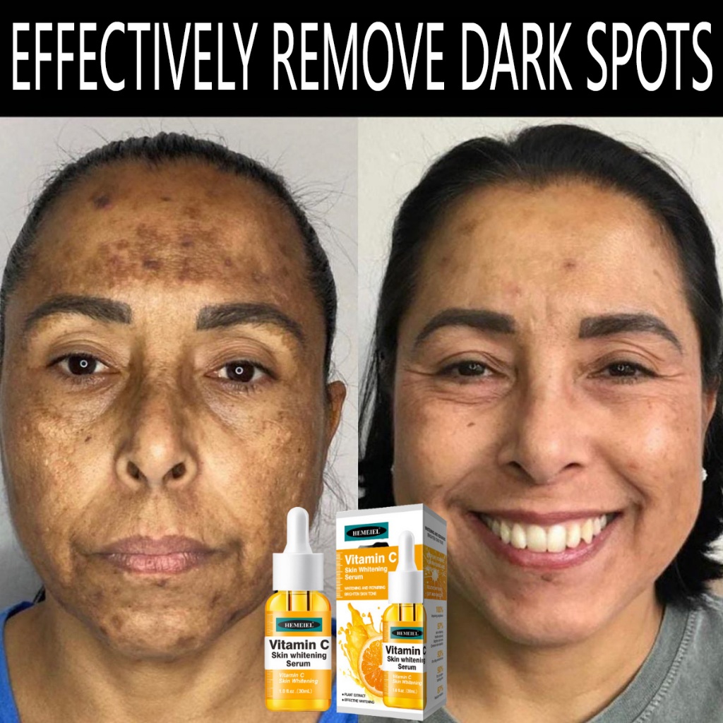 HEMEIEL Vitamin C Melasma Serum/Time Capsule Serum/Beauty Original Dark ...