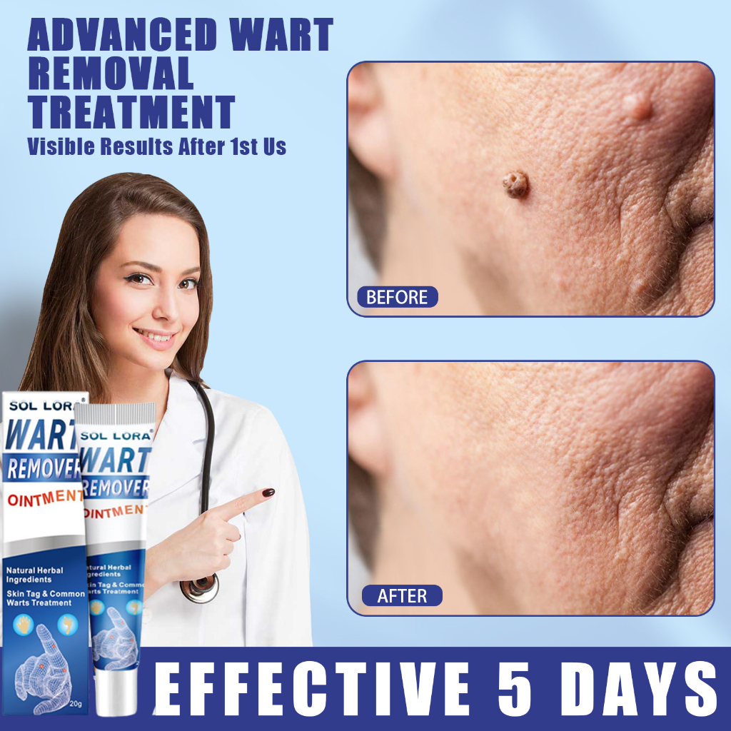 Warts Removal Original Cream Kulugo Skin Tags Mole Remover Common Warts ...