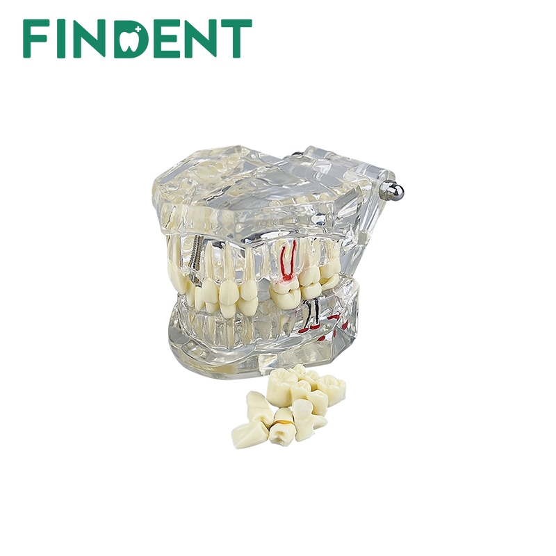 Dental Teeth Model Dental Implant Study Analysis Demonstration Teeth ...