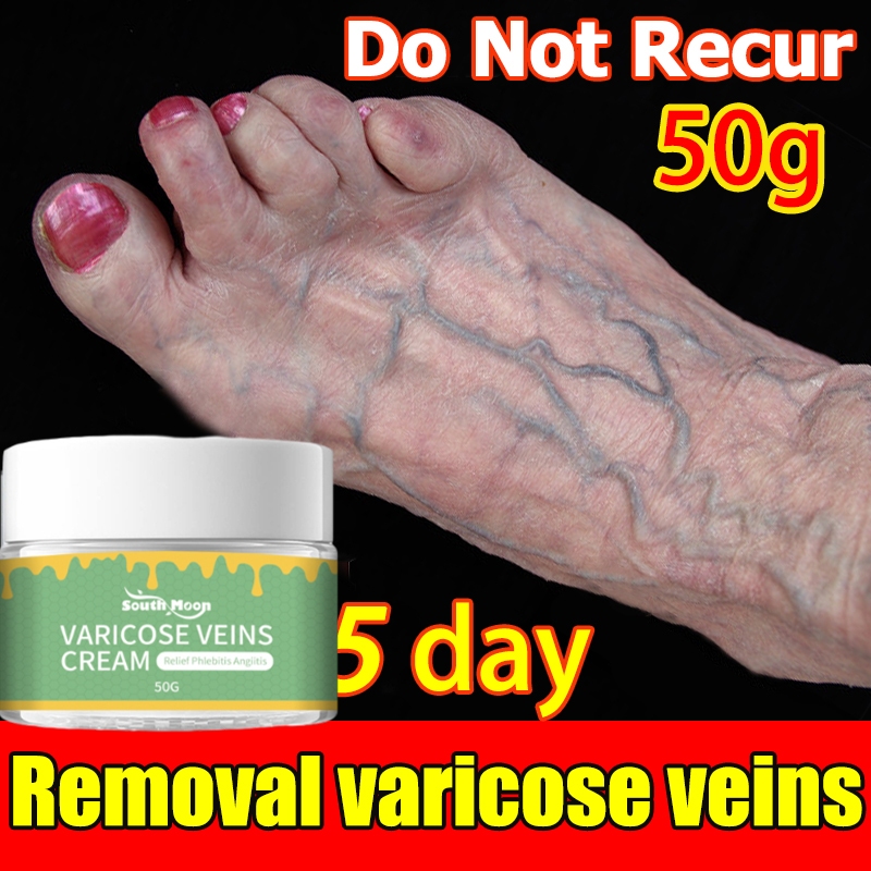 Varicose Vein Cream 50g Venous Massage Ointment Vasculitis Phlebitis ...