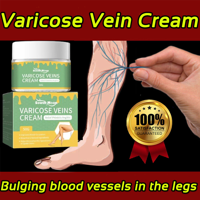 Varicose Vein Cream Spider Varicose Vein Treatment Effective Cure ...