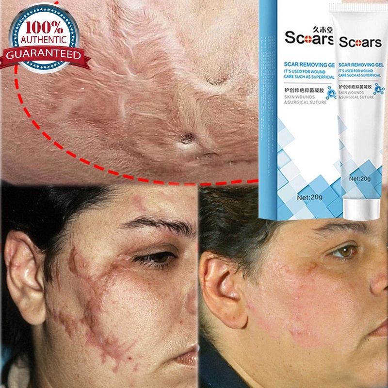 Scar Removal Cream Acne Scar Remover Remove Scar Kelloid Stretch Mark ...