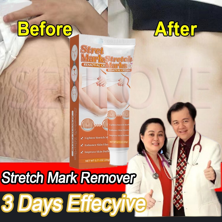 Stretch Mark Remover Cream Scar Remover Cream Anti Wrinkle Maternity ...