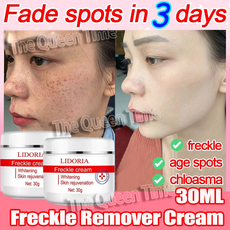 Melasma Cream Pekas Remover Effective Melasma Dark Spot Remover ...