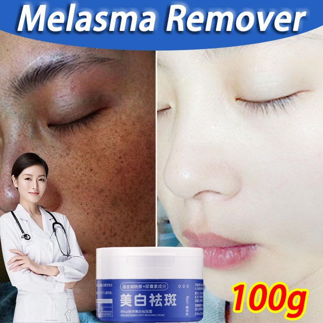 Melasma Remover Cream Whitening Freckle Cream Remove Dark Spots Melanin ...