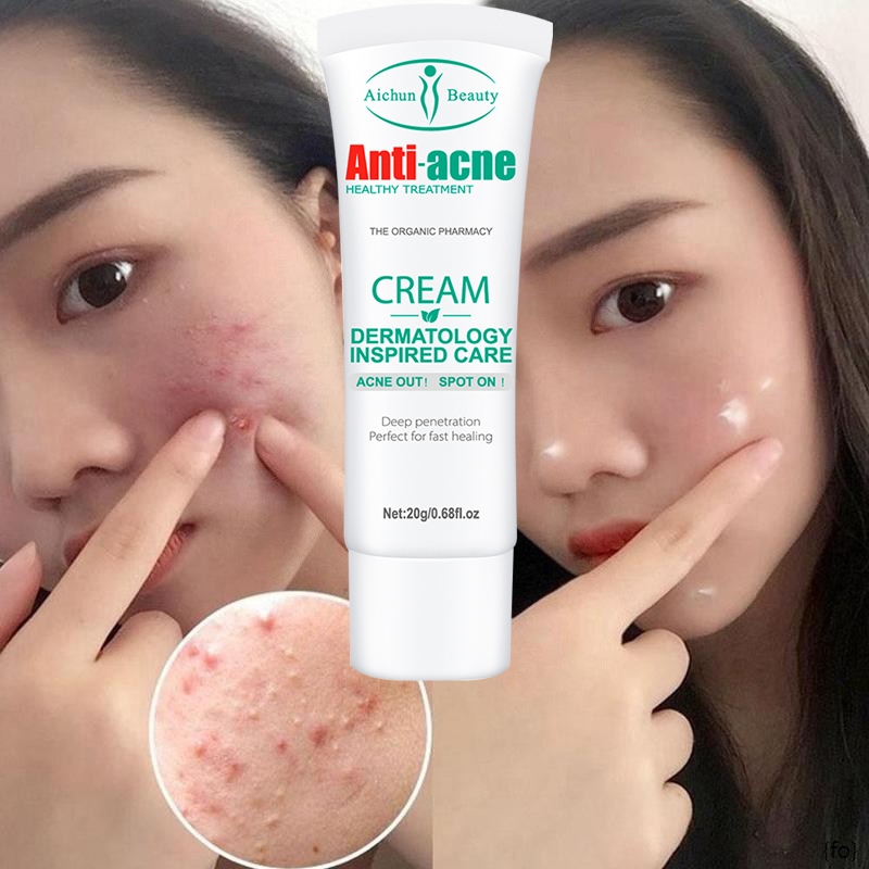 Anti acne Pimple eraser Acne remover cream Pore minimizer Pimple marks ...