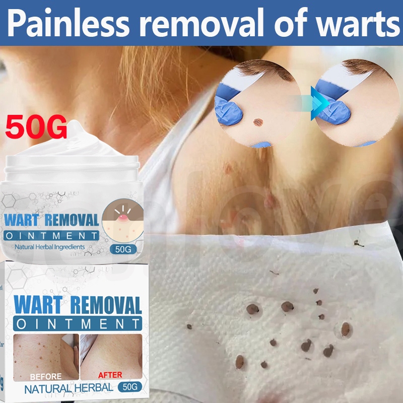 Wart Removal Cream Original Skin Tags Mole Kulugo Remover Corn Plantar ...
