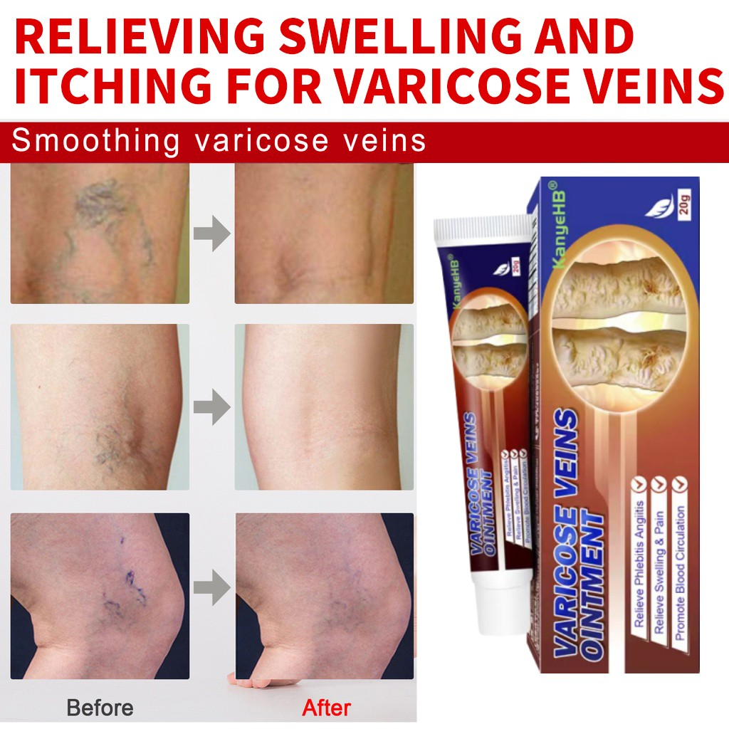 Varicose Vein Spray Remover Varicose Vein Cream Spider Vein Vasculitis ...