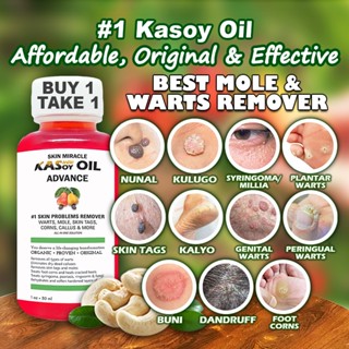Pure Kasoy Oil - Best Wart & Mole Remover, Kulugo, Skintag, Nunal ...