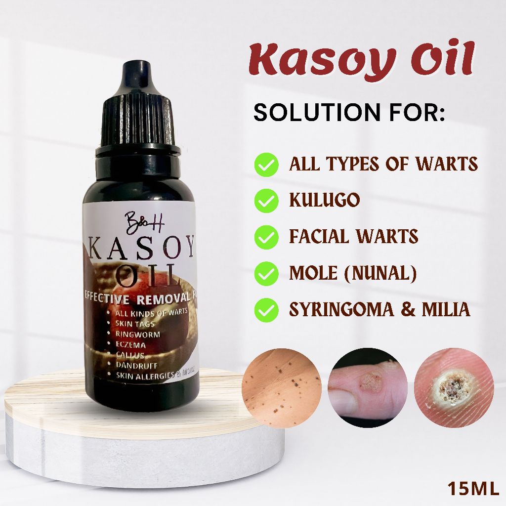KASOY OIL Kulugo & Warts Remover | Shopee Philippines