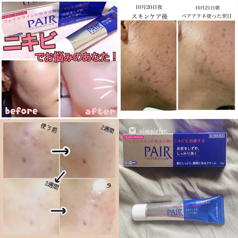 LION PAIR ® Medicated Acne Cream W | Shopee Philippines