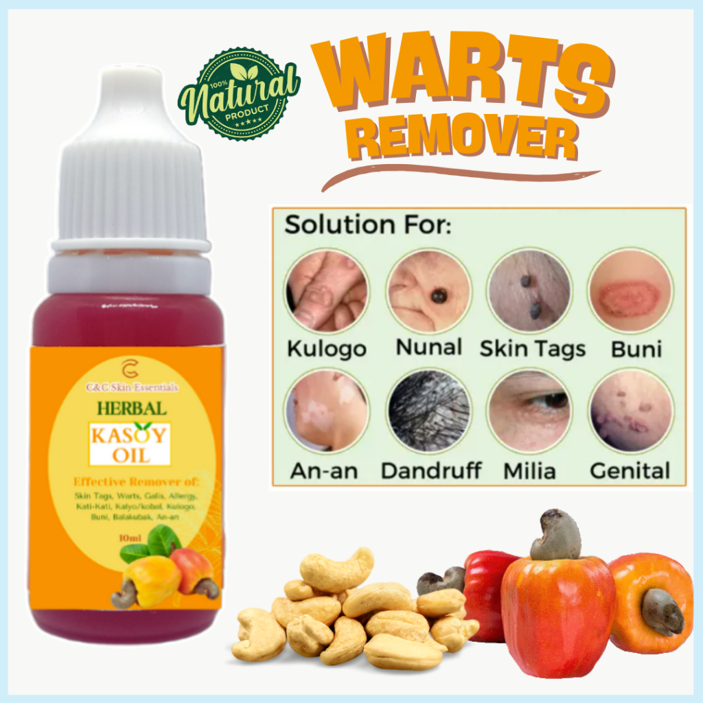 Pure Kasoy Oil 10ML: Effective Remover for Skin Tags, Nunal, Kulugo, An ...
