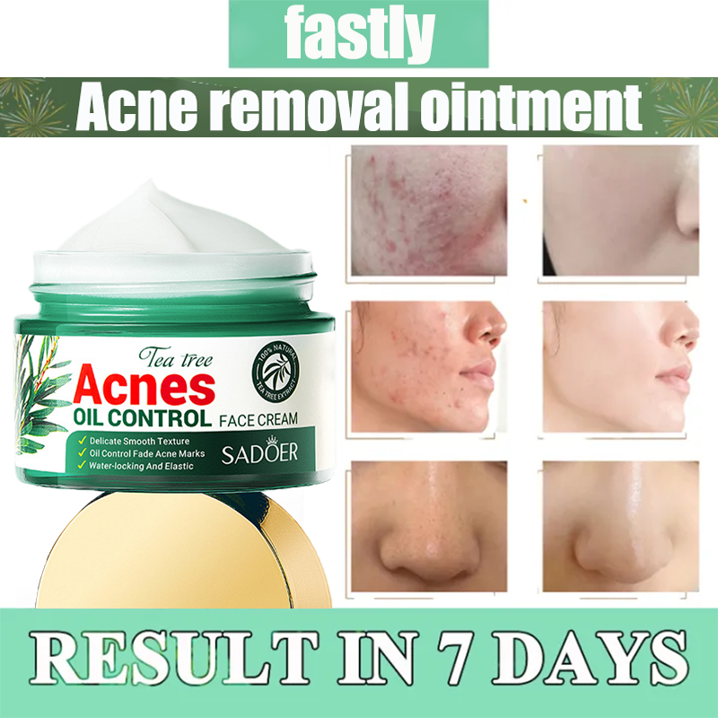 Acne Treatment Acne Scar Remover Anti Acne 50g Acne Remover Cream ...