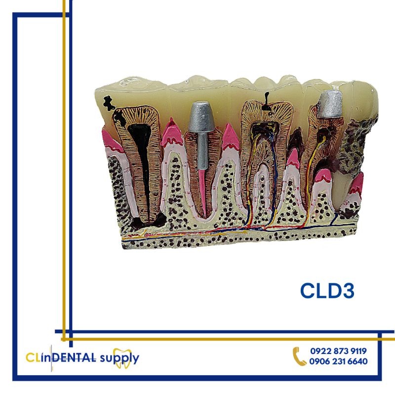 ENDODONTICS W/ POST & CORE CROWN MODEL | Shopee Philippines