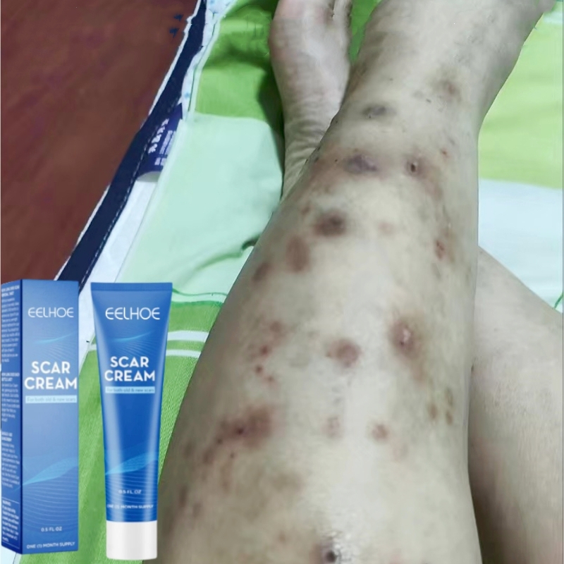 Scar remover cream Mosquito bite scar remover keloid scar cream remover ...