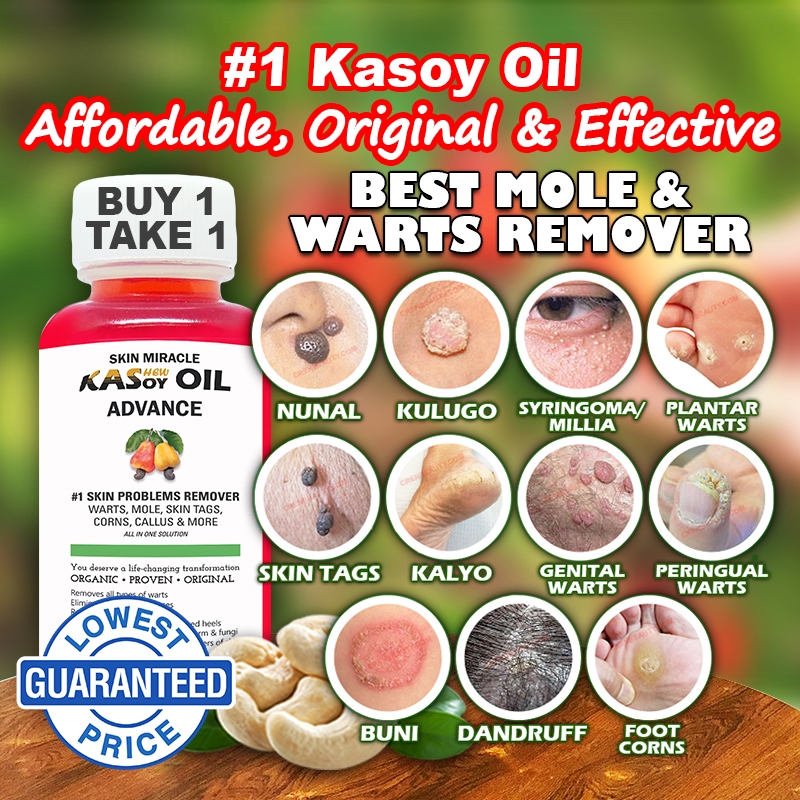 #1 Mole & Wart Remover, Kulugo, Skin tag, Nunal, Kalyo (Affordable ...