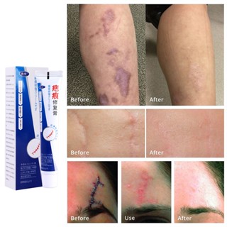 Scars Remover Cream Gel Original From Japan For Old Scar Care ...