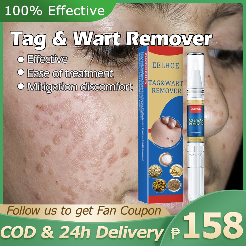 Same day del. Warts Removal Pen Kalyo Warts Remover Original Kasoy ...