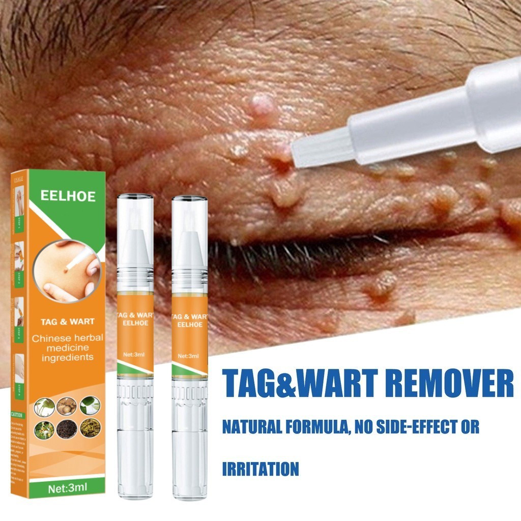Genital Wart Treatment Papillomas Removal Of Warts Liquid From Skin