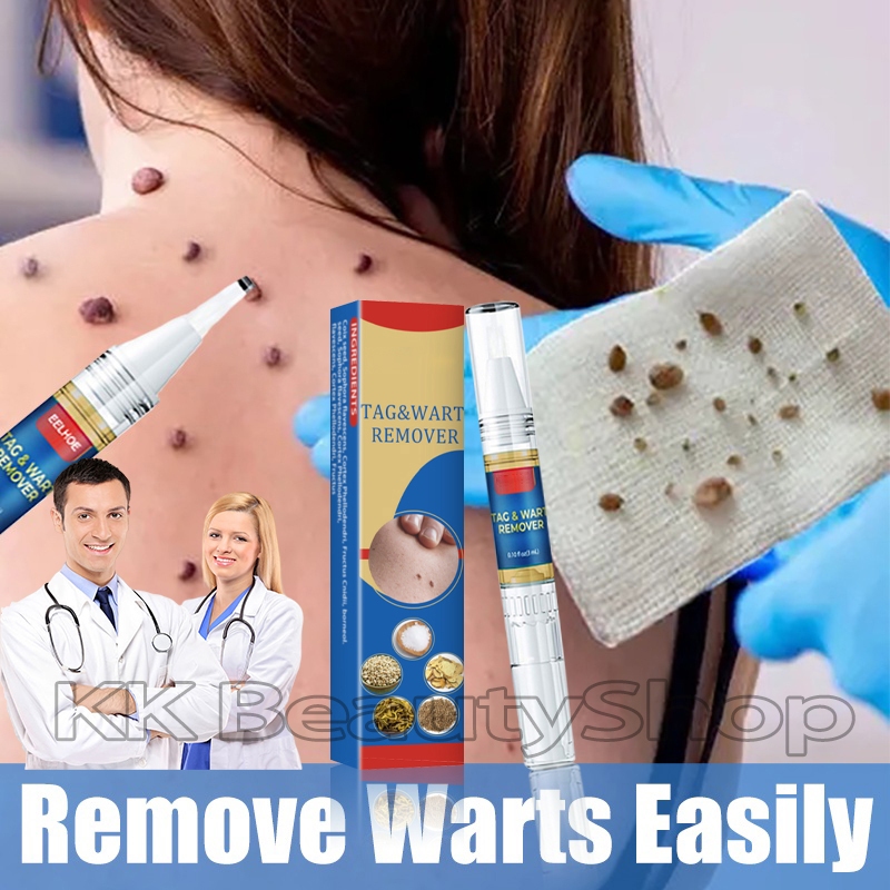 Wart Remover Pen Skin Mole Pen Anti Skin Tag Genital Wart Papillomas ...