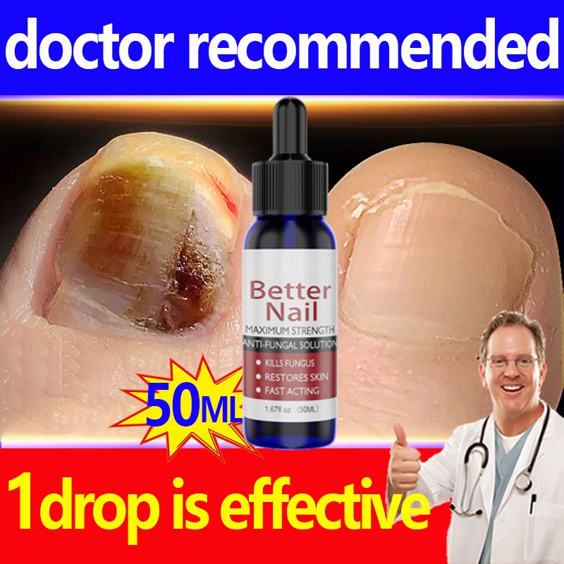 Fungal Nail Treatment Essence Anti Fungal Nail Care Improve Infection ...
