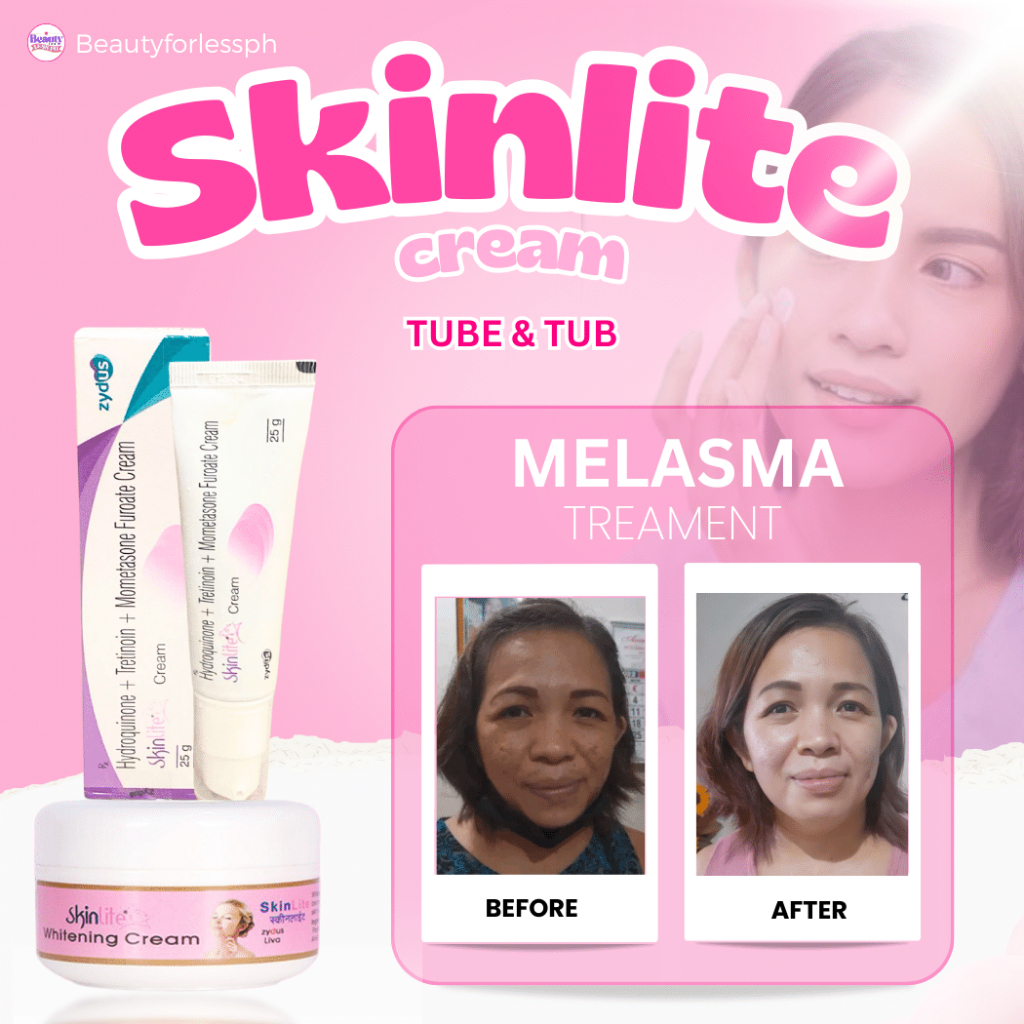 AUTHENTIC SkinLite Pekas 𝗖𝗿𝗲𝗮𝗺 Melasma Cream 𝗽𝗲𝗸𝗮𝘀 𝗿𝗲𝗺𝗼𝘃𝗲𝗿 𝗺𝗲𝗹𝗮𝘀𝗺𝗮 ...