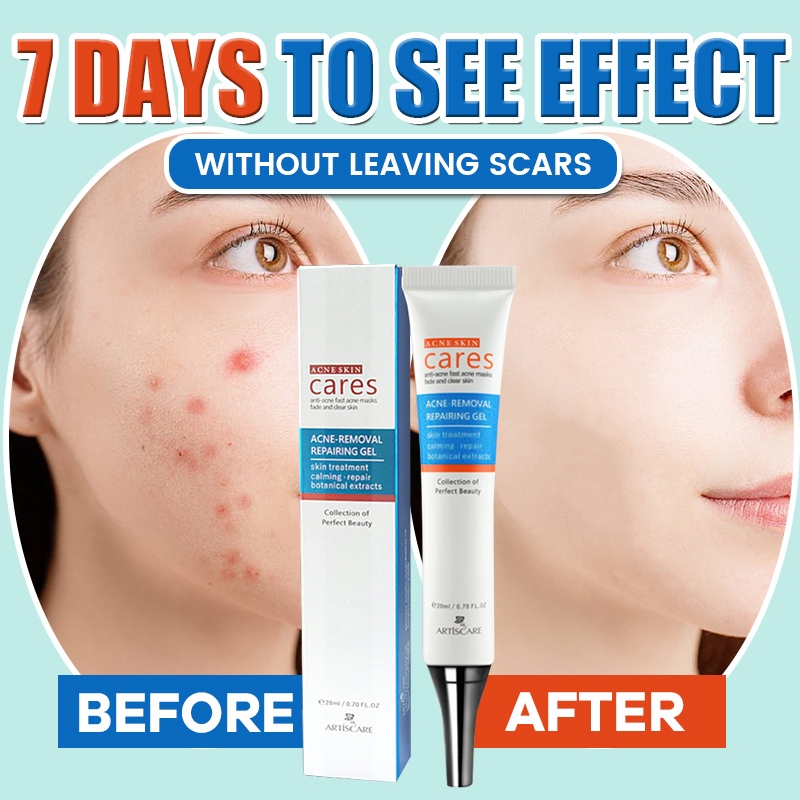 Acne remover cream Pimple eraser Pimple marks remover Moisturizer acne ...