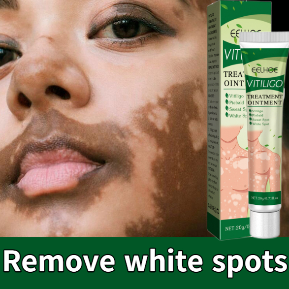 vitiligo treatment cream vitiligo cream original liquid repair white ...