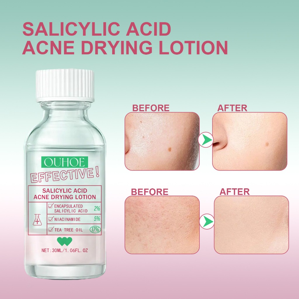 barenbliss BNB Pimple Warrior Salicylic Acid Acne Drying Lotion - Acne ...