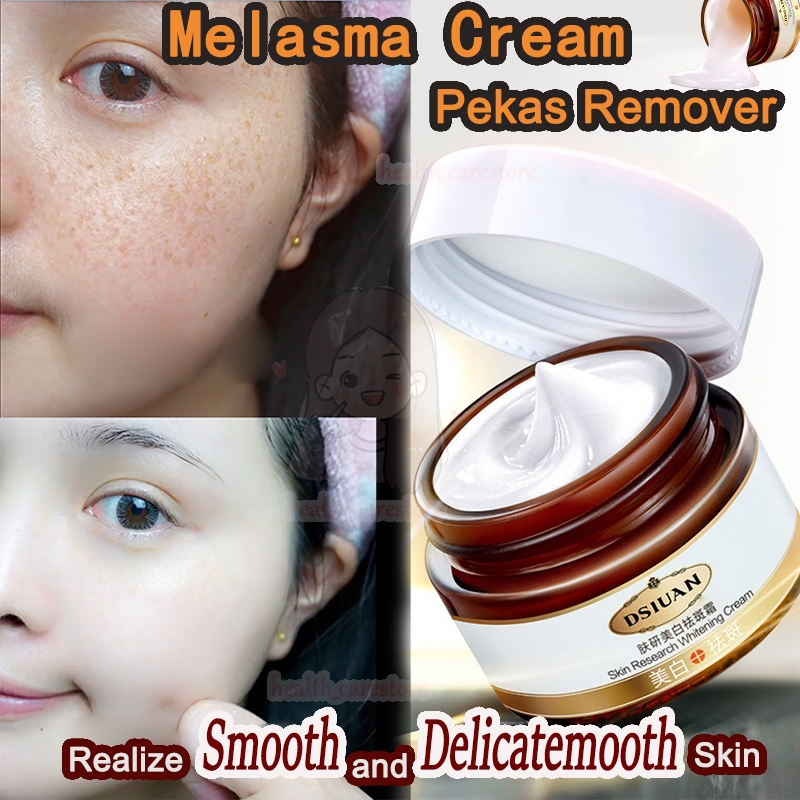 Melasma Cream Pekas Remover Anti Freckles Anti Aging Dark Spot Remover ...