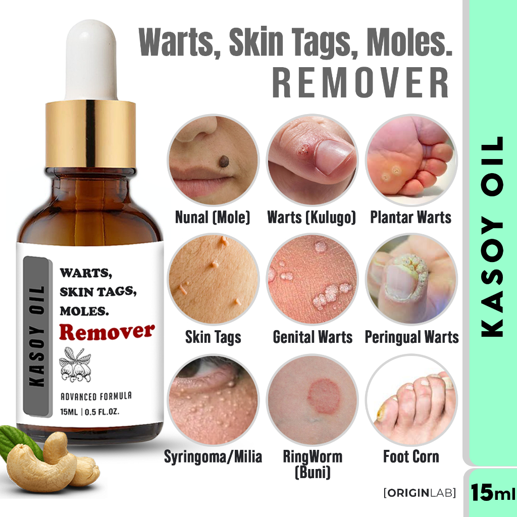 OriginLab KASOY OIL for Warts, Skin Tags, Mole Remover, Nunal, Kulugo ...