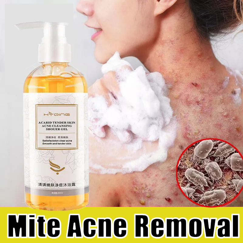 Eczema Treatment eczema body wash anti-mite shower gel treatment anti ...