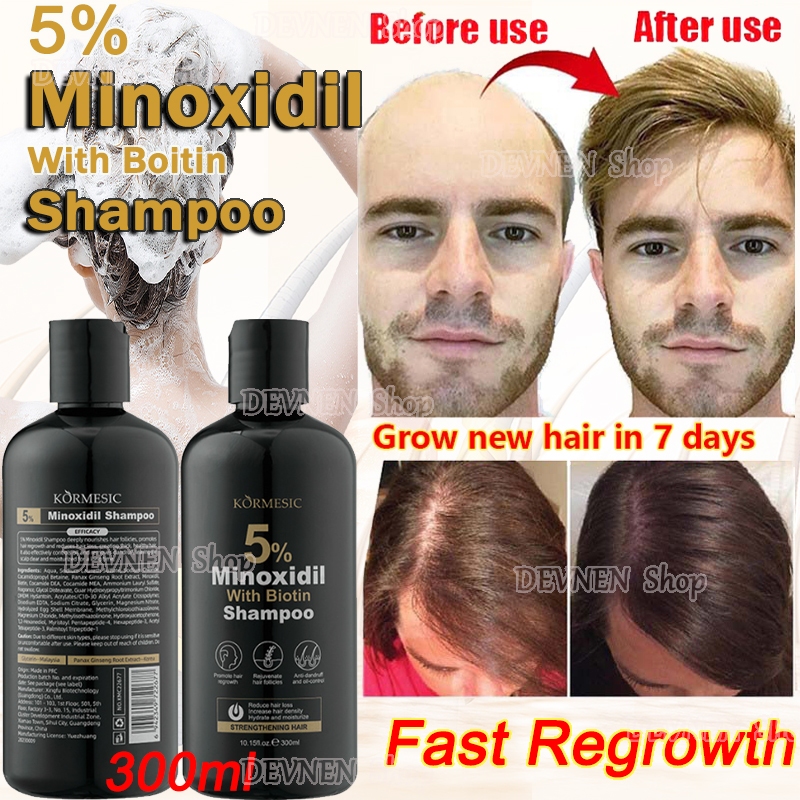 5% Minoxidil Hair Grower Shampoo With Biotin Anti Hair Loss Treatment ...