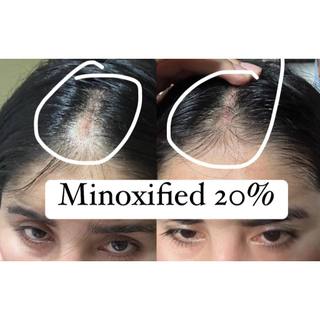 Minoxified 20%: High-Strength Minoxidil for Maximum Hair Regrowth ...