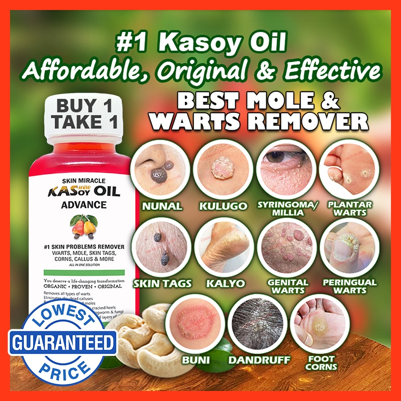 #1 Mole & Wart Remover, Kulugo, Skin tag, Nunal, Kalyo (Affordable ...