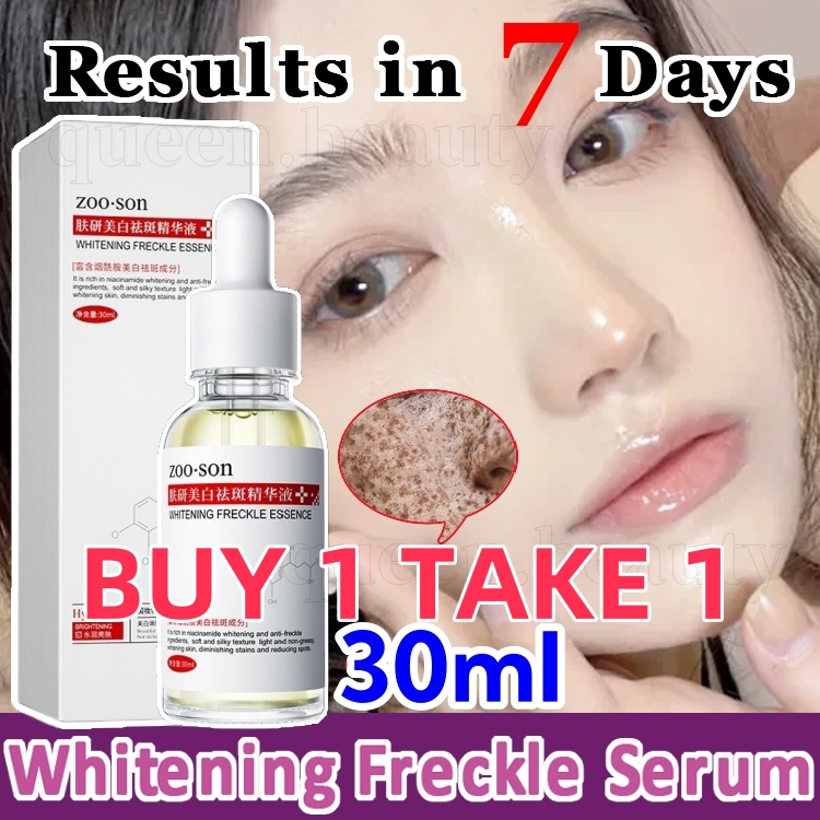 30ml Pekas Remover Serum For Melasma And Dark spot Melasma Serum Pekas ...
