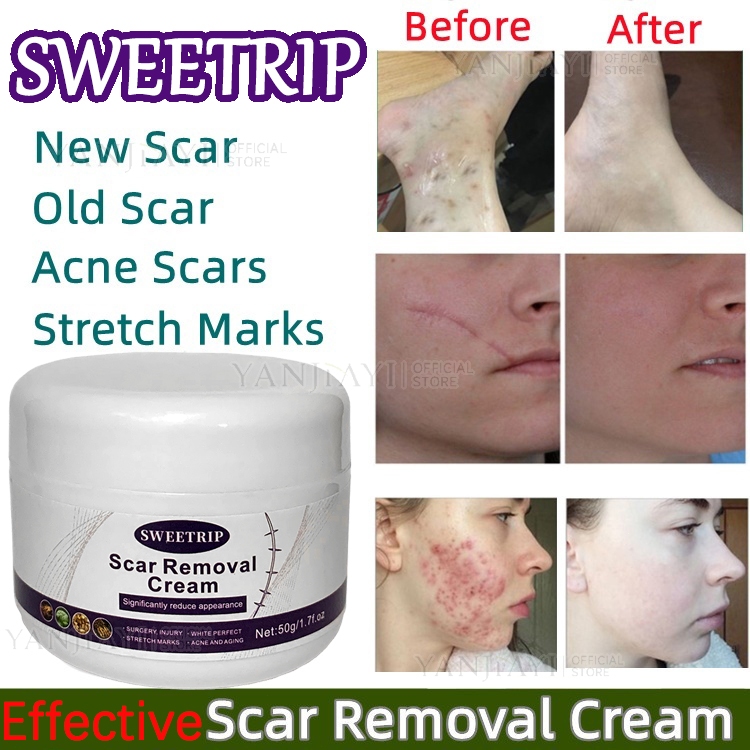 SWEETRIP Scar Remover Cream Peklat Remover Old Scar Acne Treatment ...
