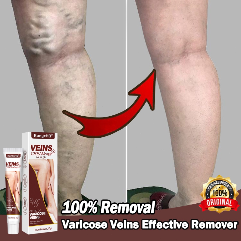 Varicose veins cream Varicose veins effective remover Spider Vein ...