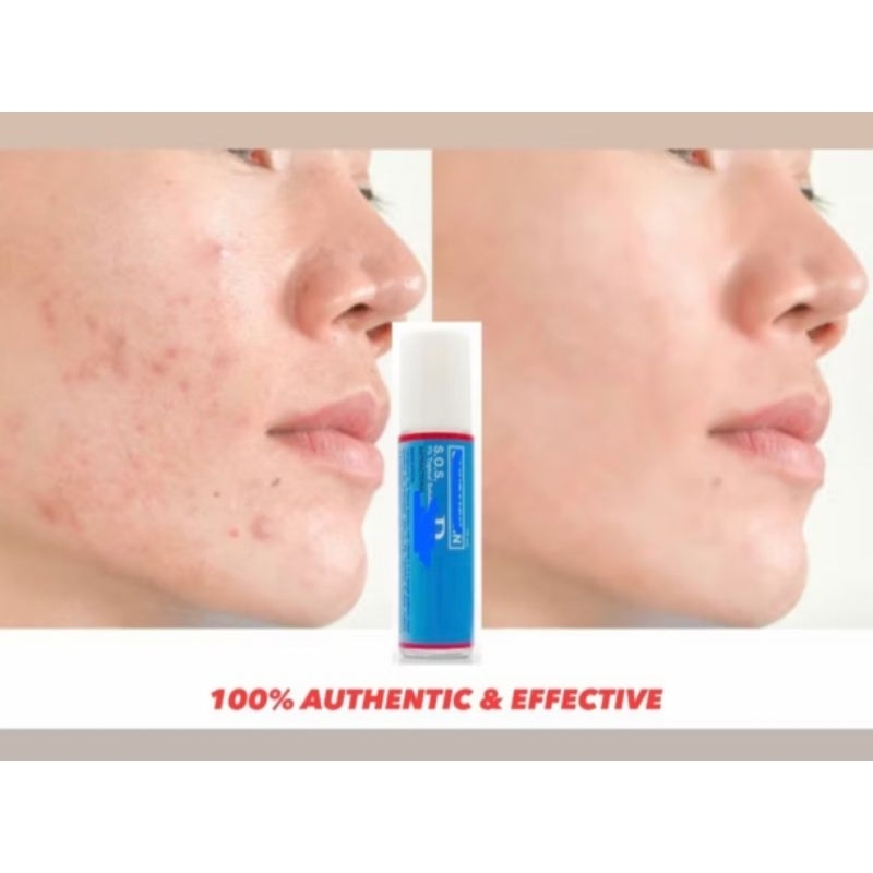 Facial roll solution for pimple | Shopee Philippines