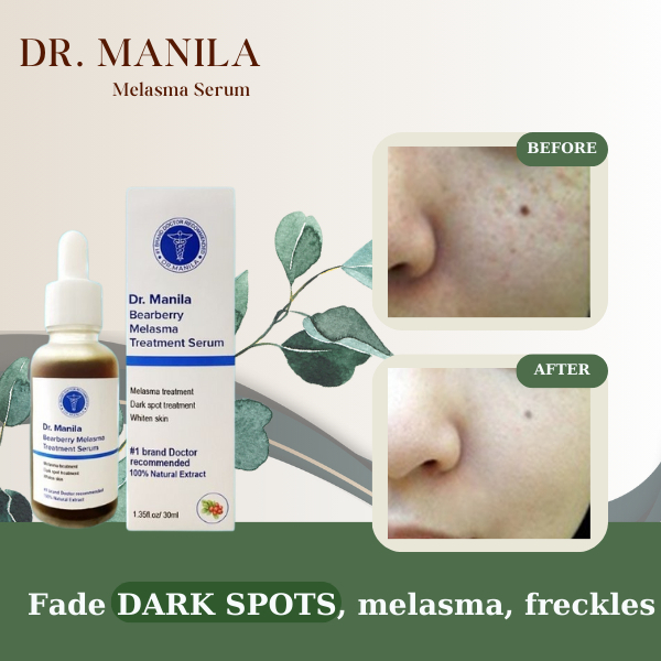 Dr. Manila - Revitalize Melasma Treatment – Reduce Hyperpigmentation ...
