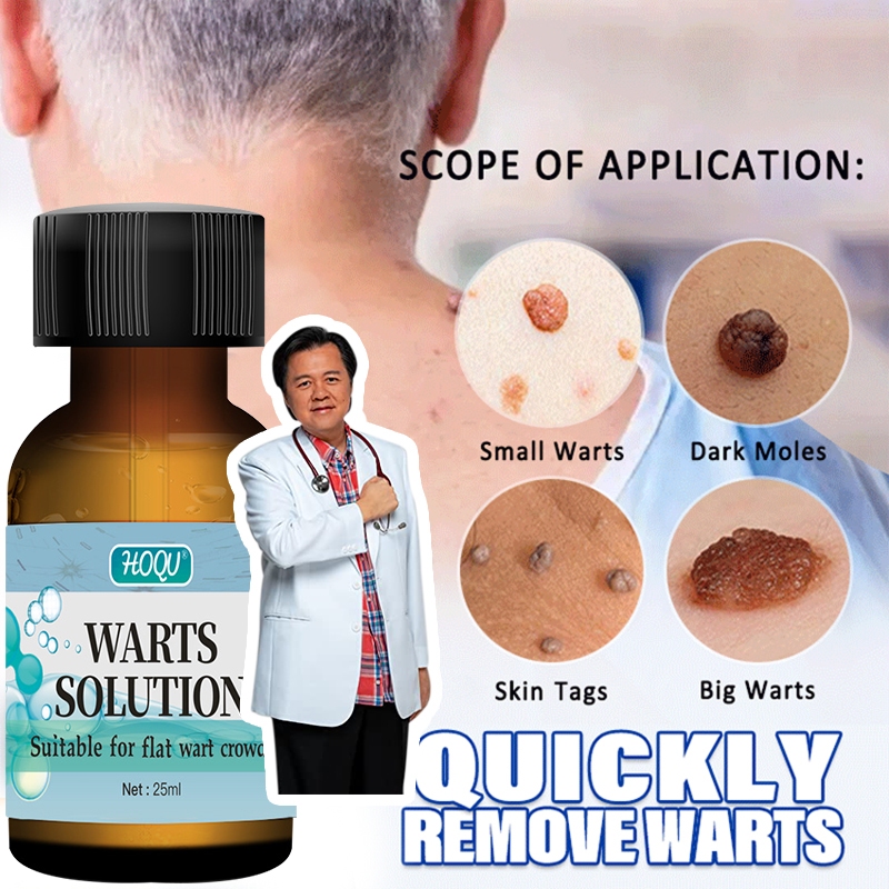 Warts Remover Solution Original Kulugo Remover Serum Oil Kalyo Buni ...