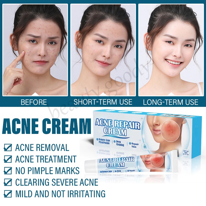 Acne cream pimple remover cream Herbal Acne remover Acne Treatment ...
