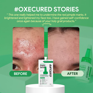 OXECURE Acne Defense Prebio Serum 5ml | Shopee Philippines
