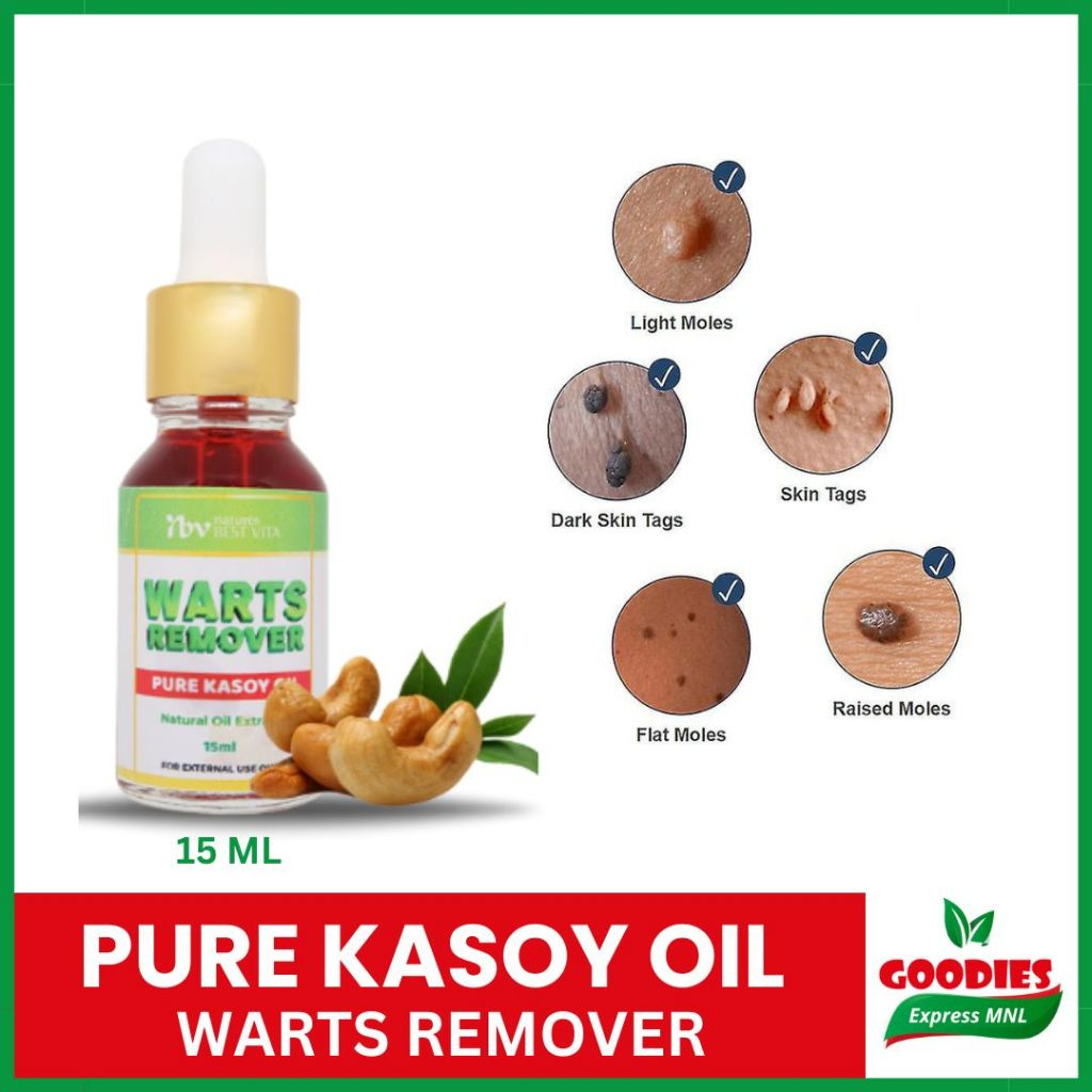 Warts Remover Pure Kasoy Oil Natures Best Vita Mole Remover Kulogo Buni ...