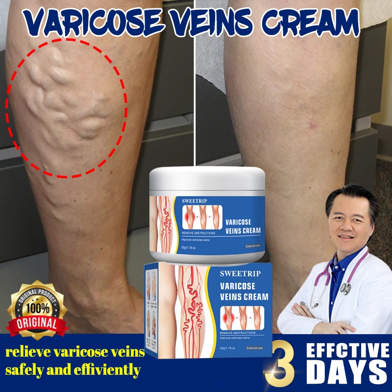 SWEETRIP Varicose Vein Remover Cream Spider Vein Pain Killer Original ...