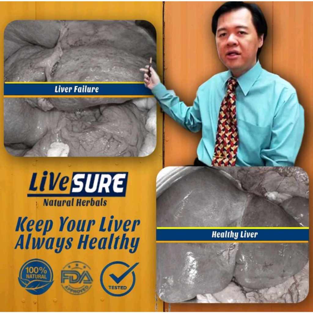 Live sure To prevent Liver Cancer, Cirrhosis, Fatty Liver Disease ...