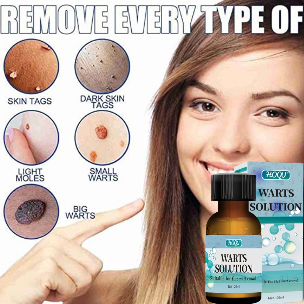 Warts Remover Original Painless Kulugo Remover Skin Tag Remover Mole ...