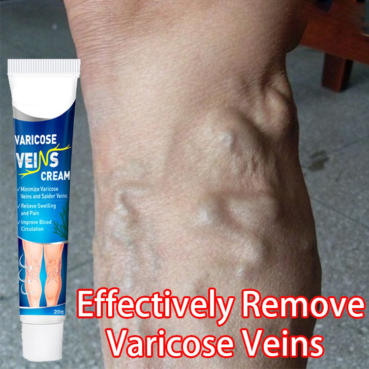 Varicose Vein Treatment Cream Varicosity Angiitis Remedy Ointment ...