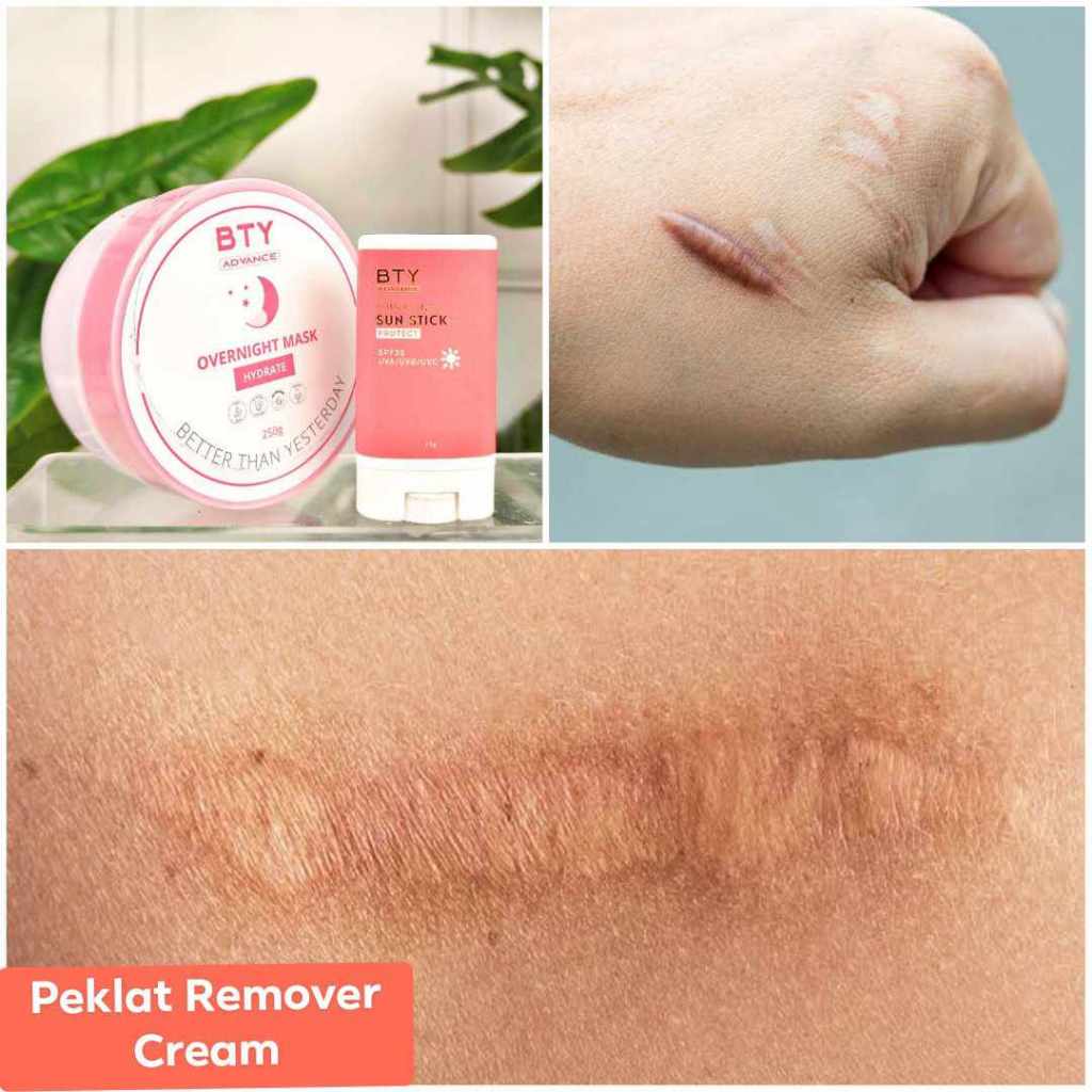BTY Overnight mask with free sunstick - PEKLAT, VARICOSE , REMOVER ...