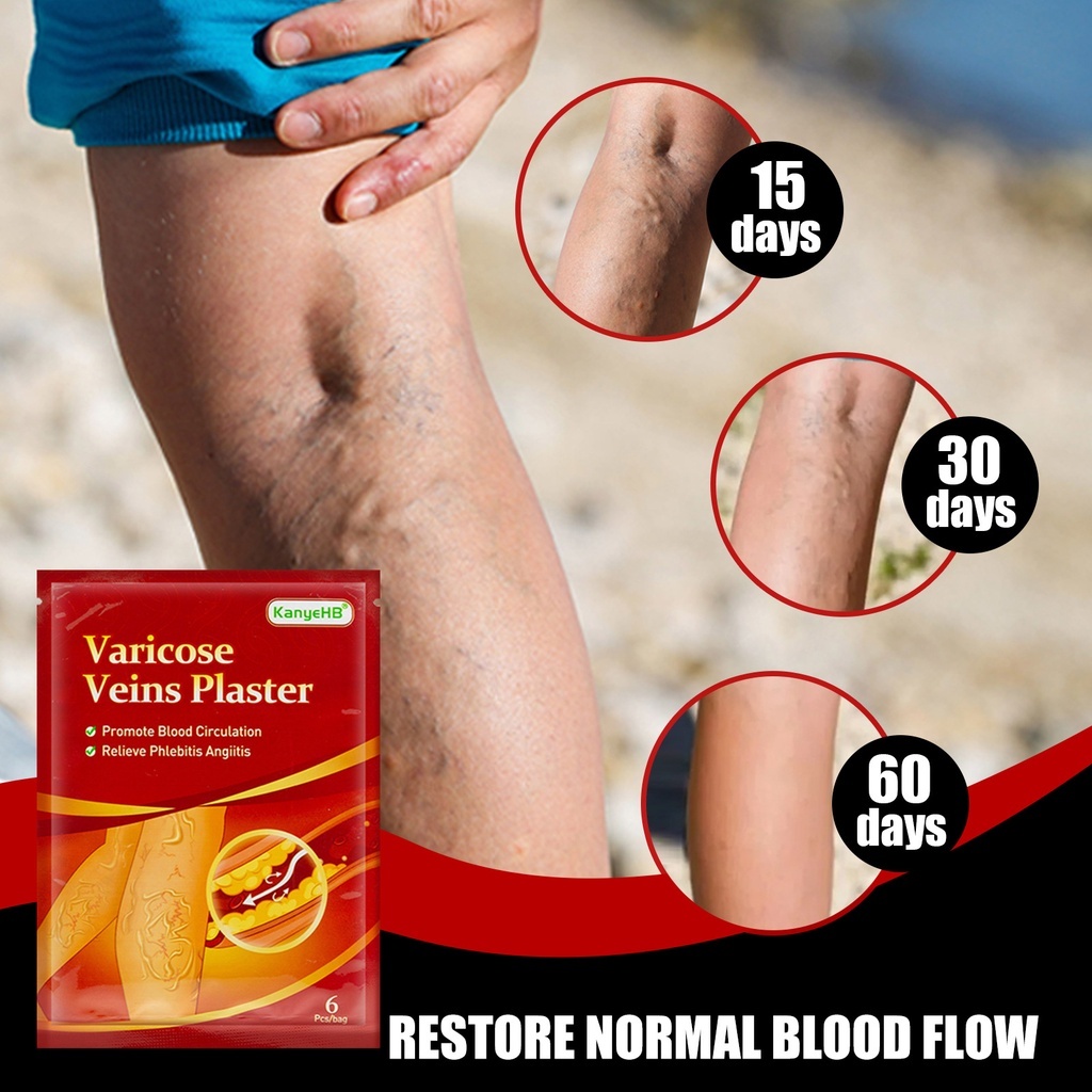 6pcs/12pcs/24pc Varicose veins remover patch pain cream plaster relief ...